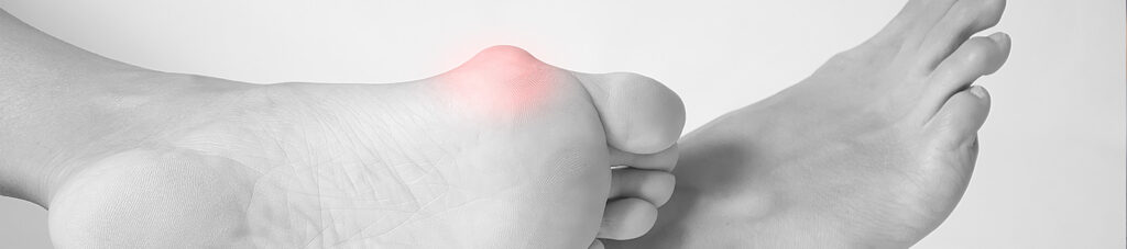 Shoe Inserts For Bunions | Bunion Inserts - Footlogics USA