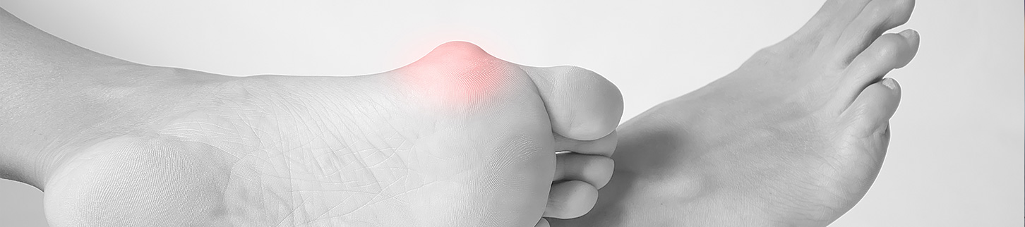 Shoe Inserts For Bunions | Bunion Inserts - Footlogics USA