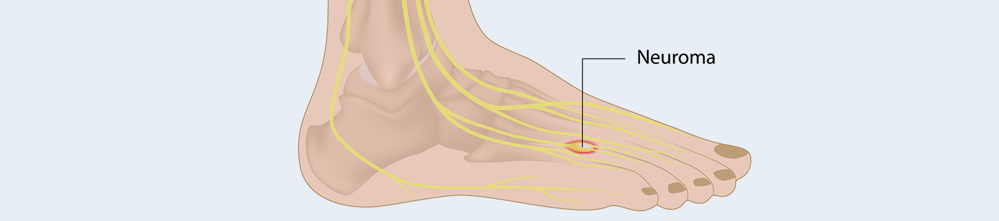 Inserts For Morton's Neuroma | Morton's Neuroma Insoles - Footlogics USA